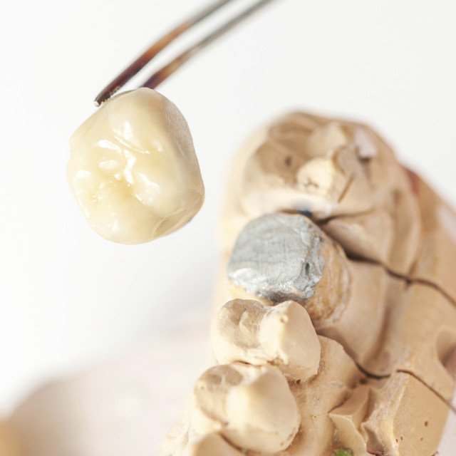 Crown and Bridge work – Mace Dental